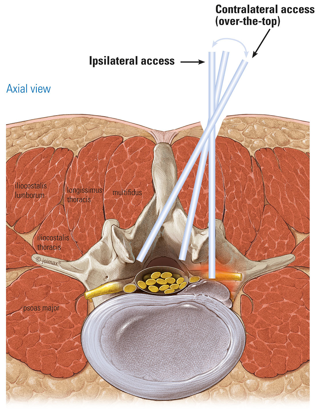 老王的故事：脊柱内镜手术让我重新恢复活力 - 好大夫在线