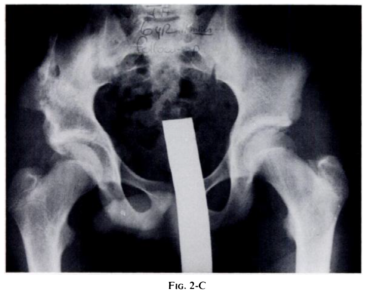 LCPD特发性儿童股骨头坏死：Legg-Calvé-Perthes病的三联截骨术_小儿股骨头坏死_小儿股骨头坏死治疗方式 - 好大夫在线