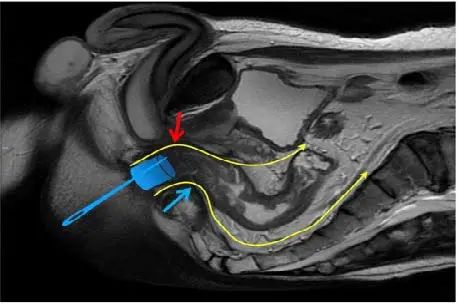 TaTME技术要点_直肠癌_直肠癌治疗方式 - 好大夫在线