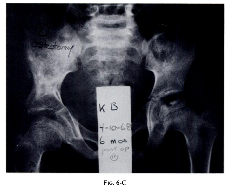 LCPD特发性儿童股骨头坏死：Legg-Calvé-Perthes病的三联截骨术_小儿股骨头坏死_小儿股骨头坏死治疗方式 - 好大夫在线