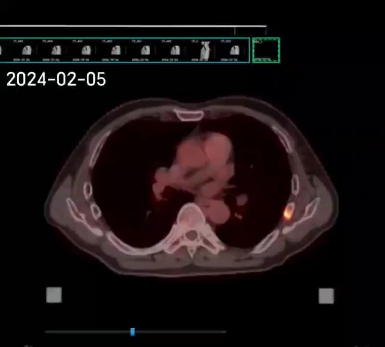 5D放疗-4DCT定位（模拟定位）+PET/CT OR PET/MR功能影像（多模态影像图像融合）_放射诊断_介绍_治疗介绍 - 好大夫在线
