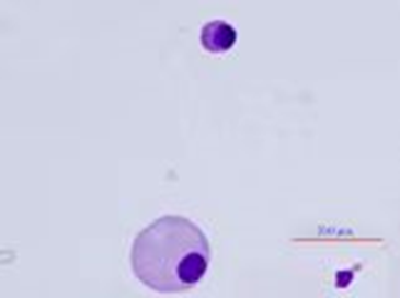 一个被遗忘在犄角旮旯的精液检测项目——精液脱落细胞学_男性不育_男性不育检查 - 好大夫在线