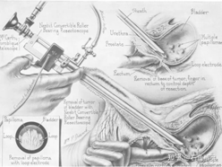 非肌层浸润膀胱癌的手术方案，从TURBt到ERBT的前世今生_膀胱癌_膀胱癌治疗方式 - 好大夫在线