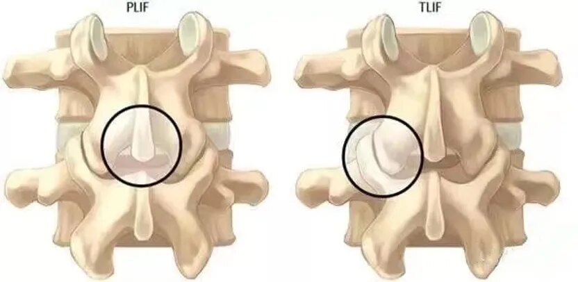 后路腰椎椎体间融合术PLIF及TLIF_脊柱侧弯_脊柱侧弯治疗方式 - 好大夫在线