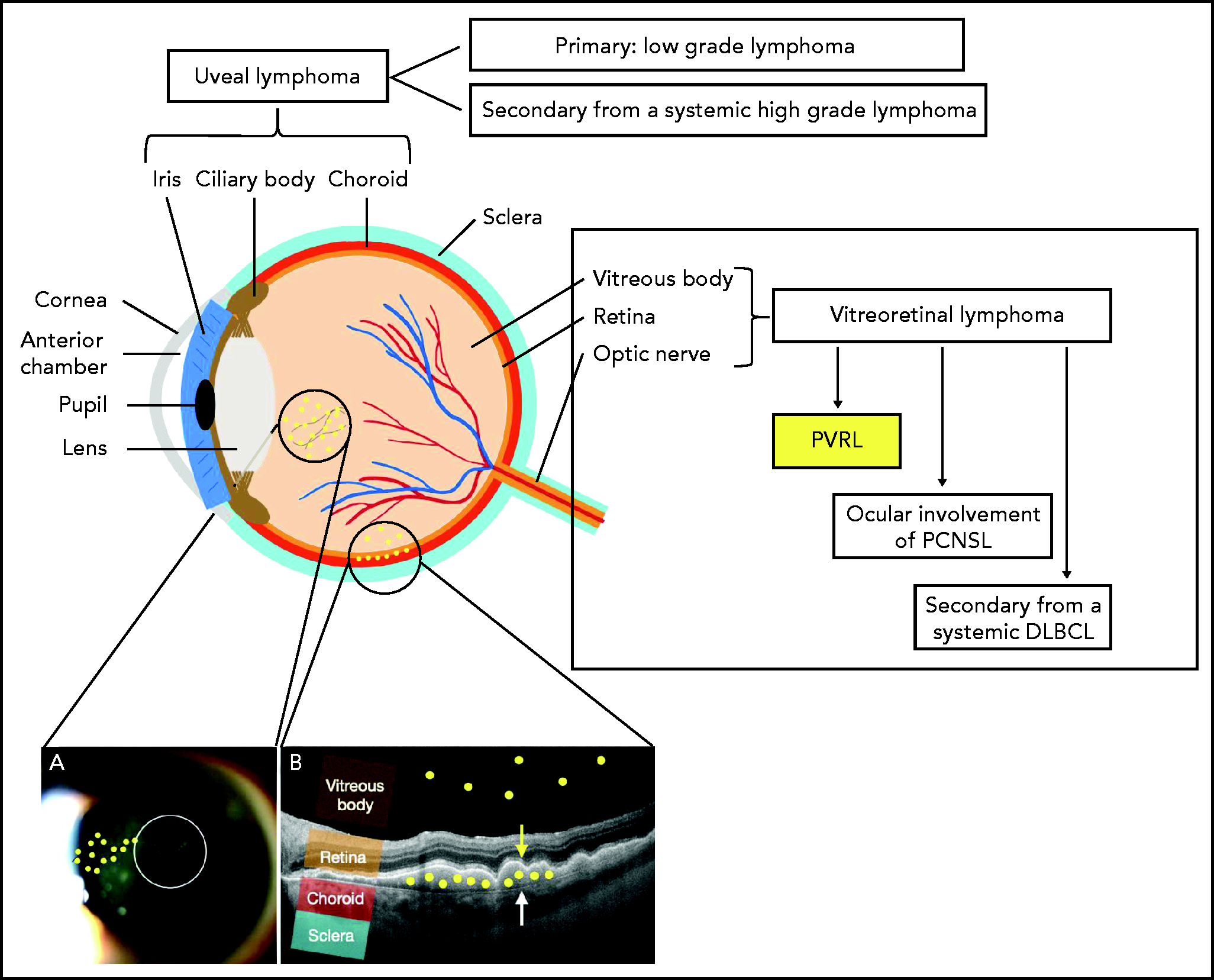 原发眼部淋巴瘤（Primary ocular lymphoma）的疾病分类和分子学特征概述_淋巴瘤_淋巴瘤介绍 - 好大夫在线