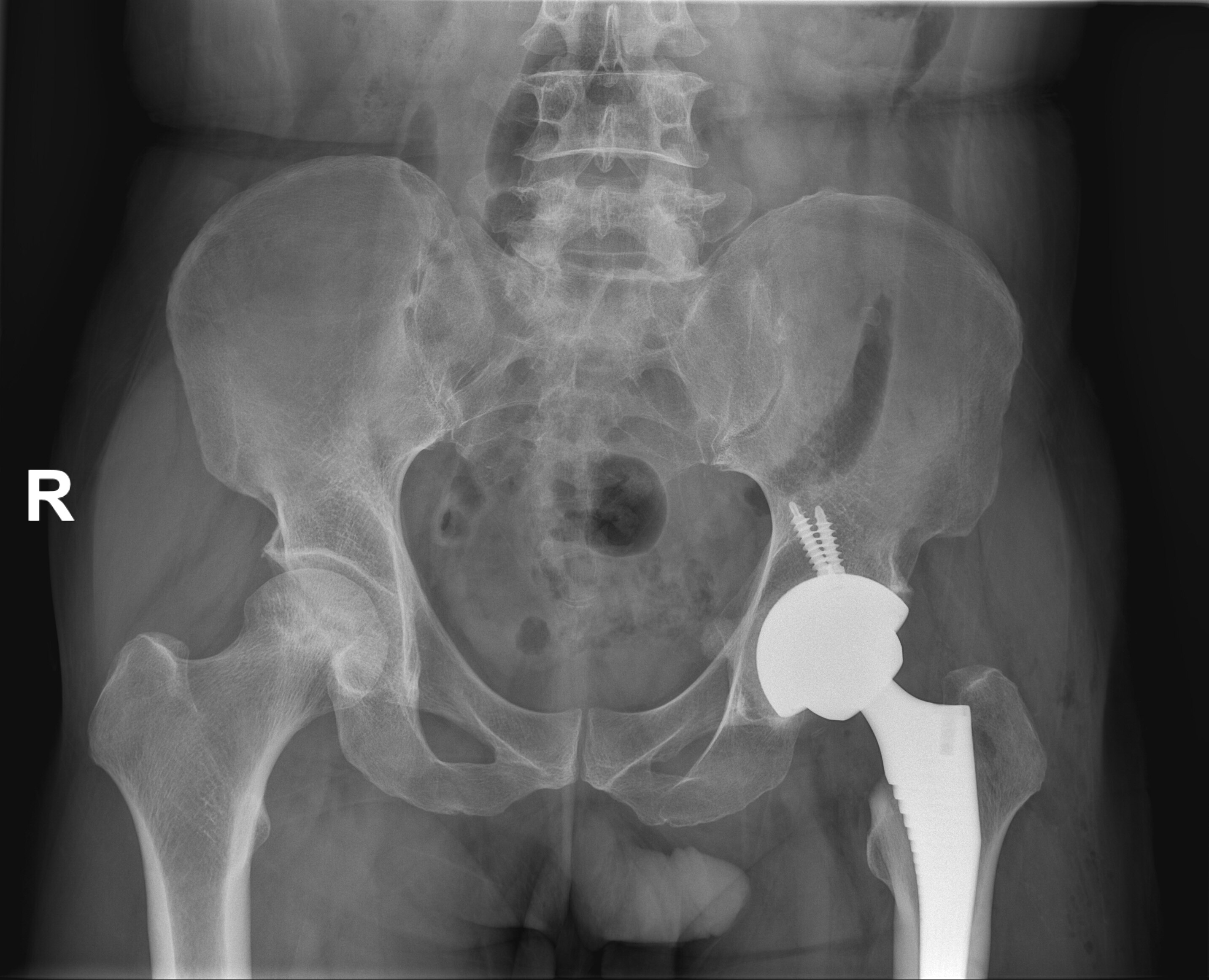 DAA（直接前入路）微创髋关节置换术_髋关节置换术_髋关节置换术治疗介绍 - 好大夫在线