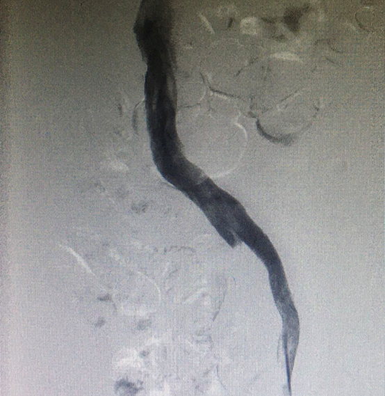 髂静脉压迫综合征(Cockett syndrome) 诊治经验及典型病例集锦_深静脉血栓形成_深静脉血栓形成发病原因 - 好大夫在线