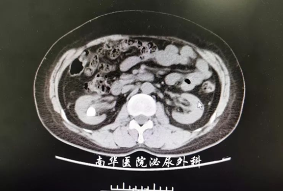 超微通道经皮肾镜Supermini PCNL (SMP)结石患者的福音 - 好大夫在线