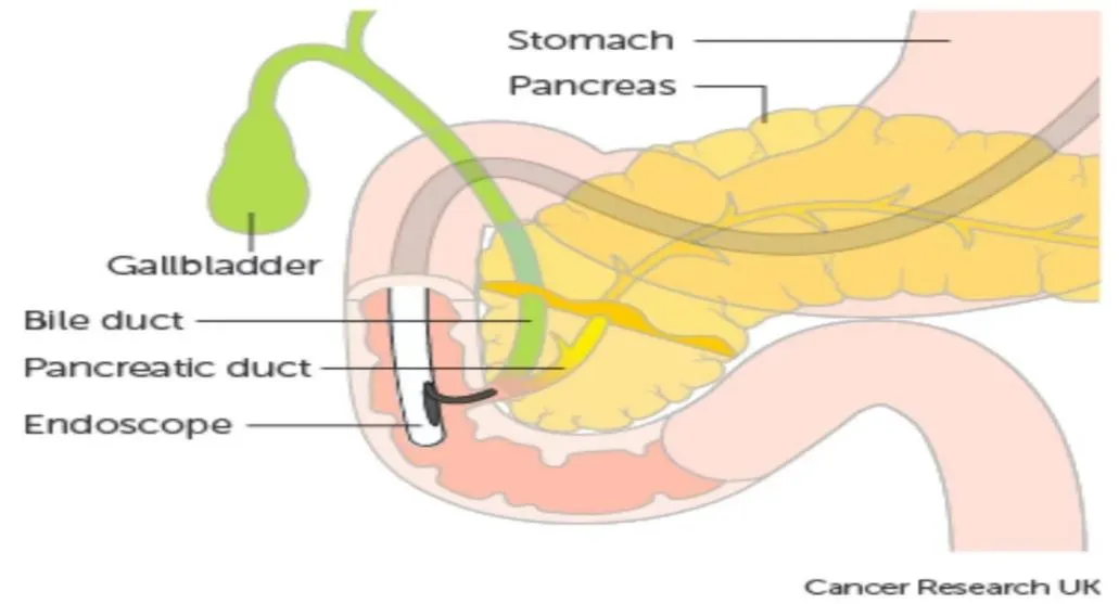 传说中的口中取石术——ERCP_胆管结石_胆管结石治疗方式 - 好大夫在线
