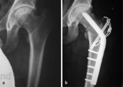 Legg-Calvé-Perthes病（LCPD）：诊断与治疗原则 - 好大夫在线
