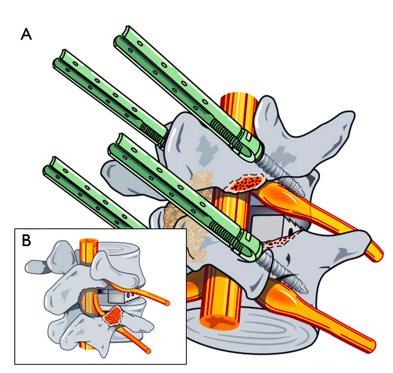 Step By Step：MIS-TLIF微创经椎间孔腰椎融合术 - 好大夫在线