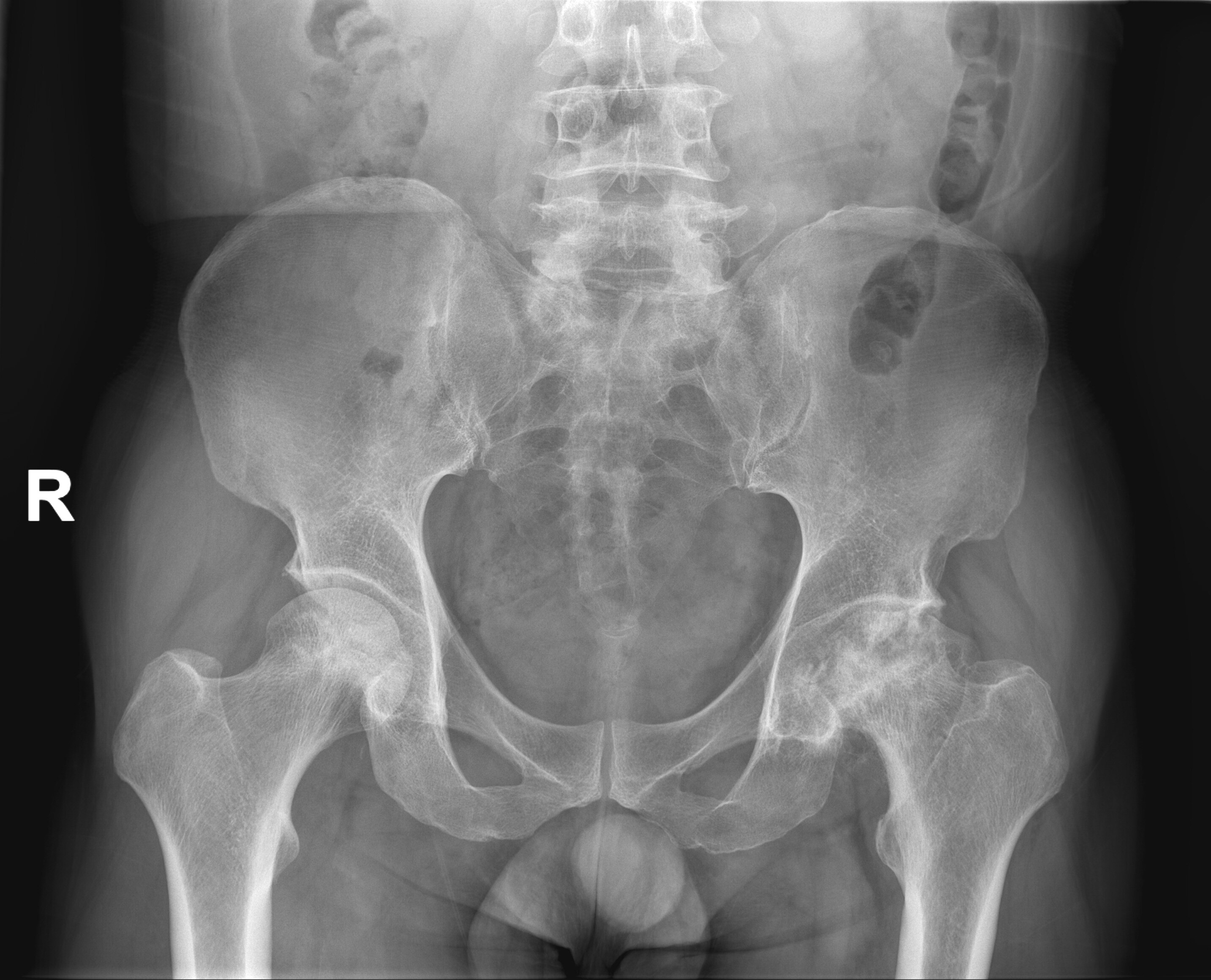 DAA（直接前入路）微创髋关节置换术_髋关节置换术_髋关节置换术治疗介绍 - 好大夫在线