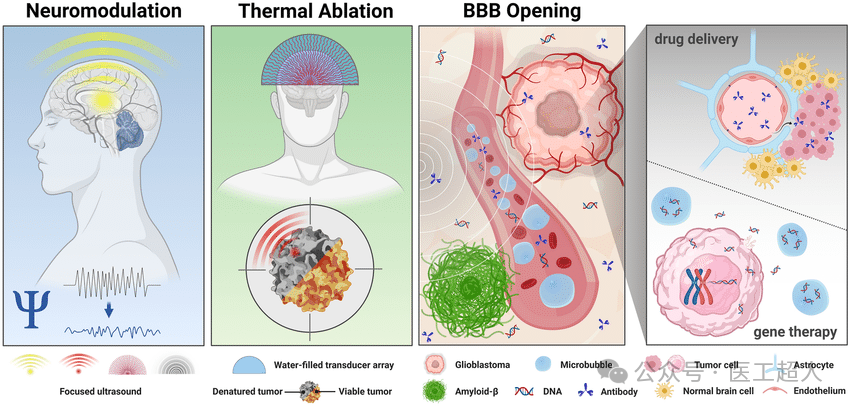深度解析 | LIFU低强度聚焦超声在非侵入性神经调控领域的潜在机制与应用 - 好大夫在线