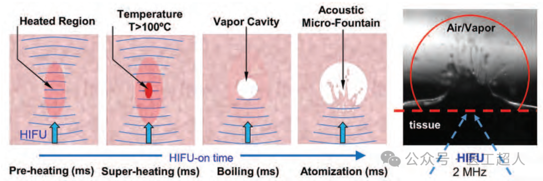 深度解析 | LIFU低强度聚焦超声在非侵入性神经调控领域的潜在机制与应用 - 好大夫在线