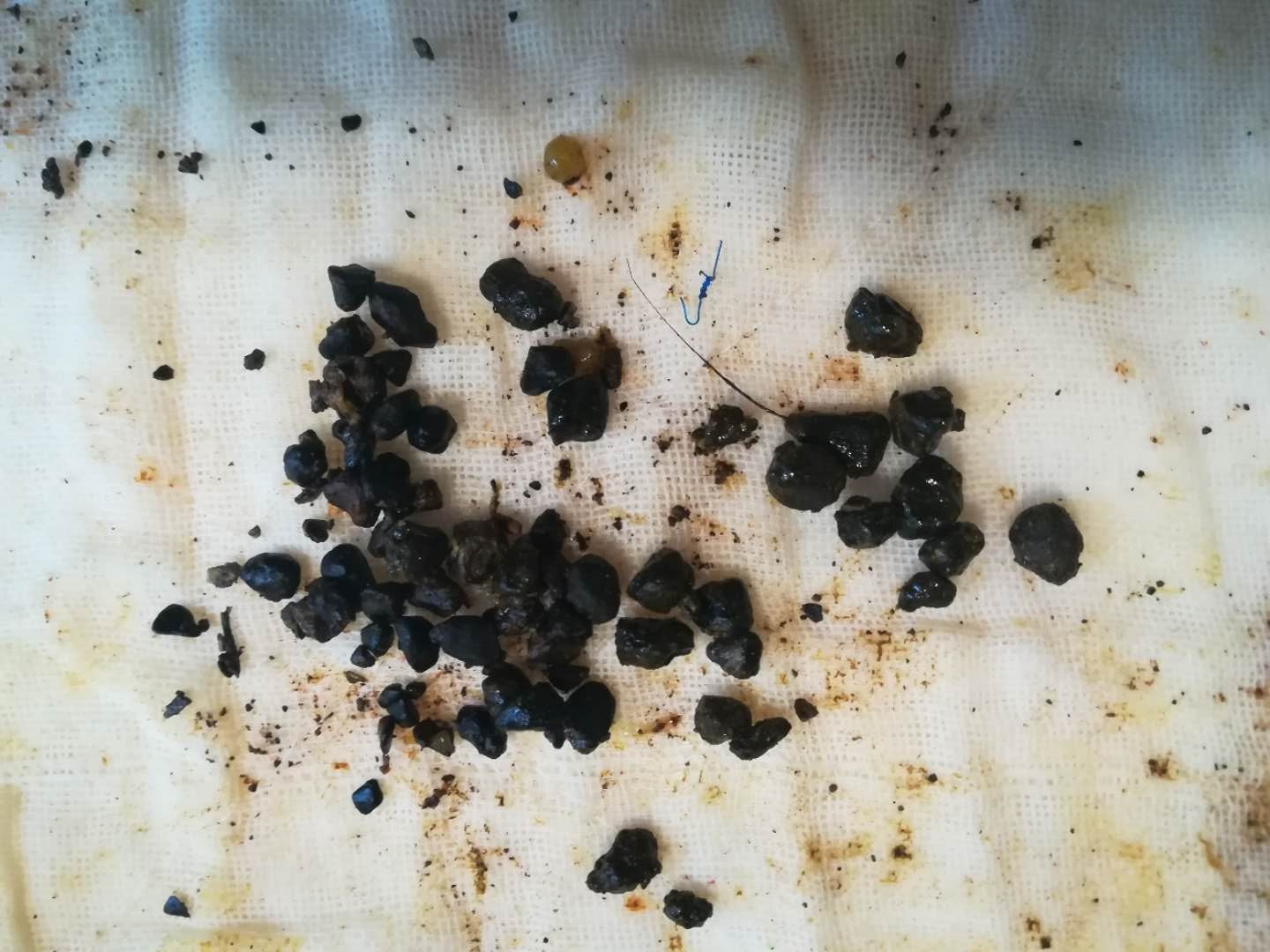 重庆医科大学附属第二医院为一名沈阳患者成功实施经皮经肝胆道镜碎石取石术（PTCSL）-春雨医生