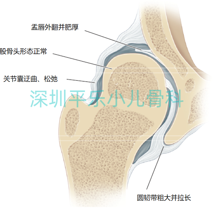 儿童发育性髋关节发育不良（DDH）系列科普---（一）认识DDH - 好大夫在线