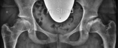 Legg-Calvé-Perthes病（LCPD）：诊断与治疗原则 - 好大夫在线